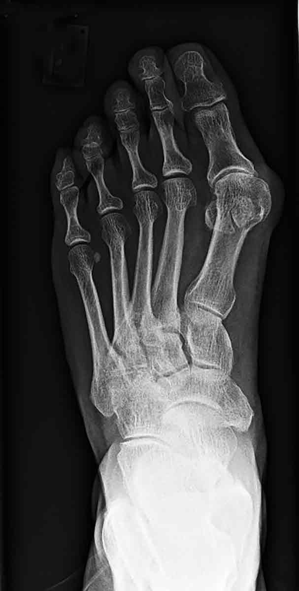 Die Behandlung vom Hallux Valgus – Journal eins